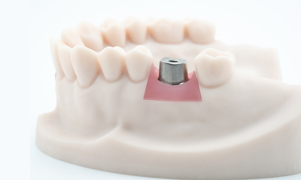 Custom Abutments - Method Dental Labs